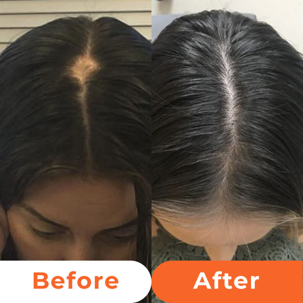 Hair Transplant Alternative Temecula, CA | Southern California Hair ...